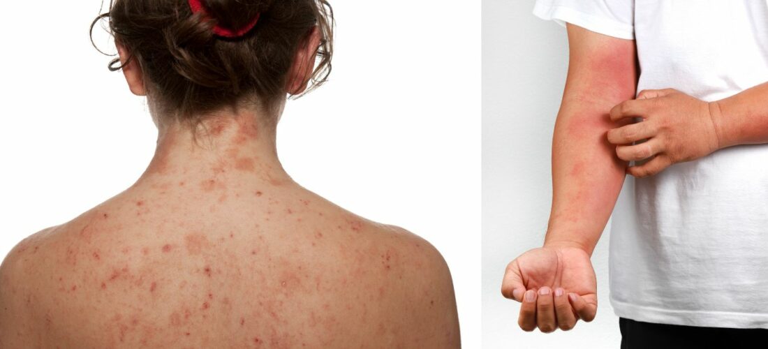 Blog Centro de Atención Integral en Asma y Alergia